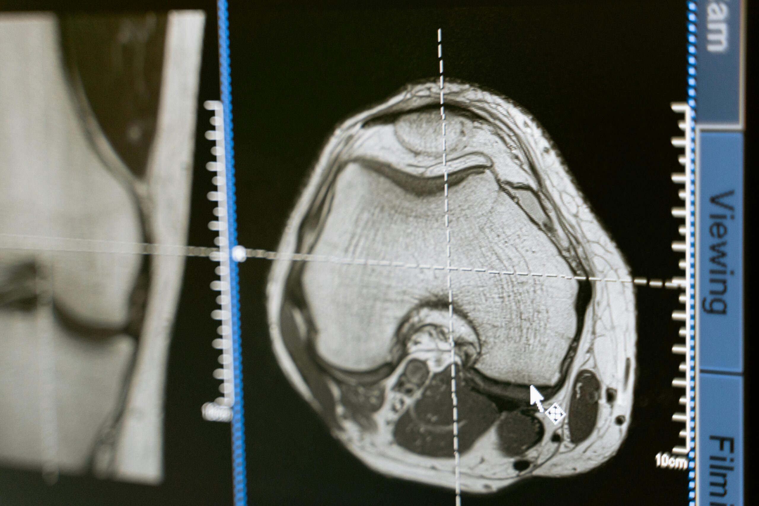 Patellar Stabilisation - NAPIER ORTHOPAEDICS